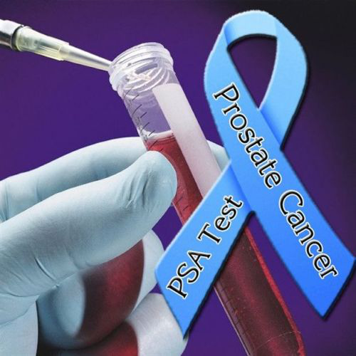 PSA Test Detection Of Carcinoma Of The Prostate PSA Test Detection Of Carcinoma Of The Prostate