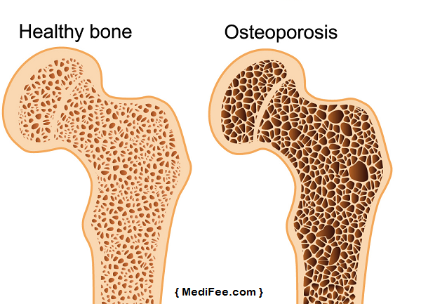 Osteoporosis Types Causes Diagnosis And Preventive Measures Osteoporosis Types Causes Diagnosis And Preventive Measures