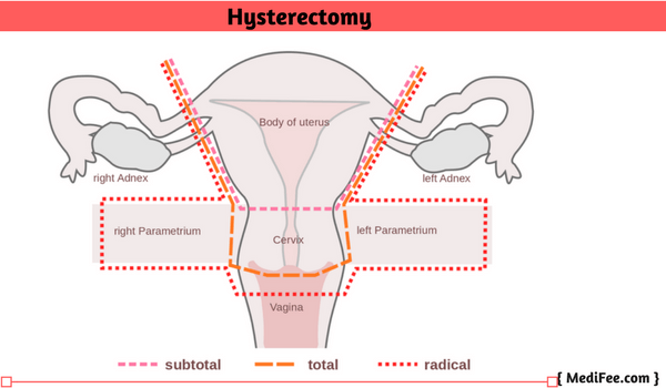 Uterus Removal Surgery Hysterectomy Full Procedure Risks And